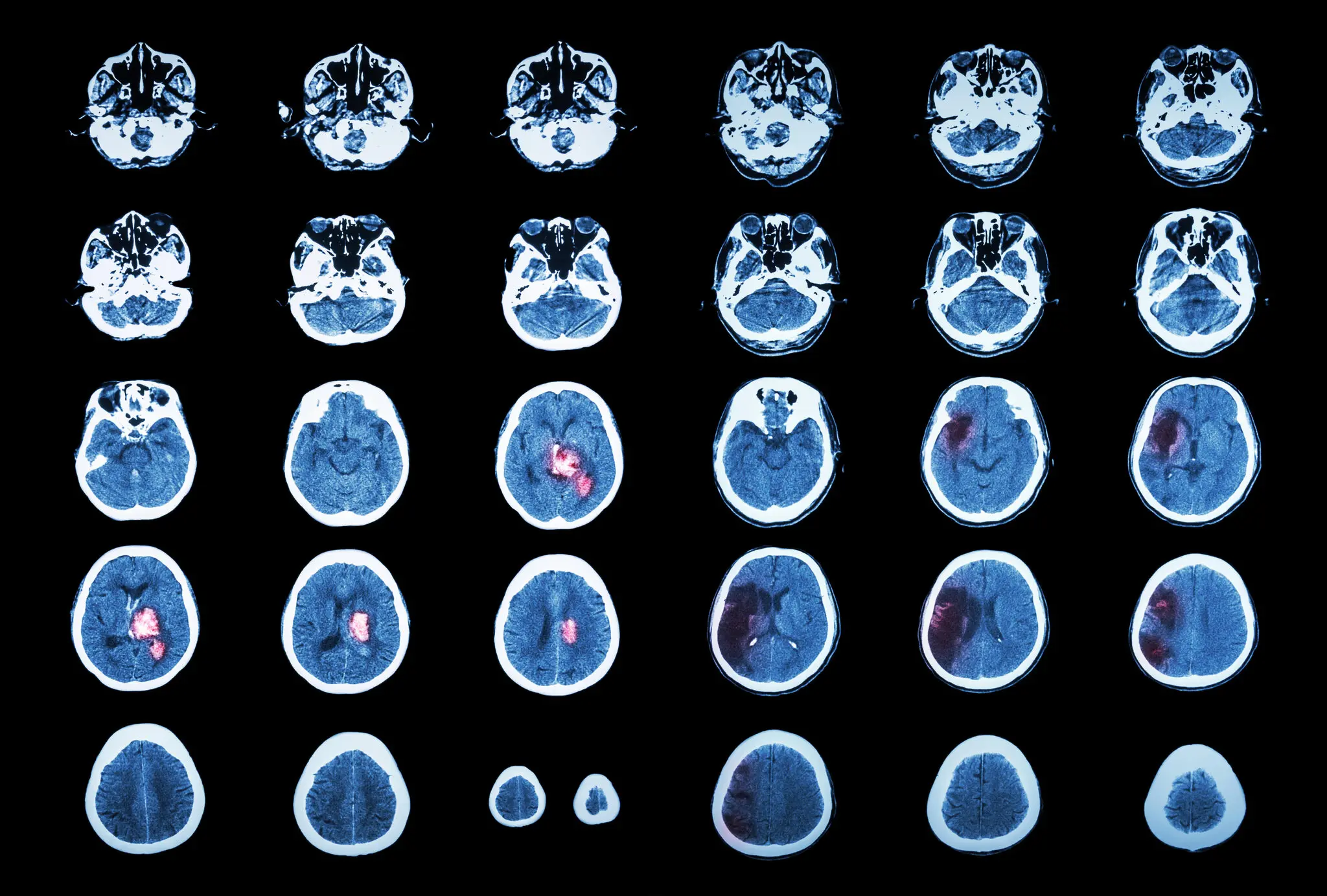CanStroke in the New York Times - CanStroke Recovery Trials